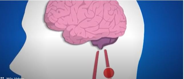Síntomas Del Ictus Cómo Actuar Y Prevenir Micof Muy Ilustre